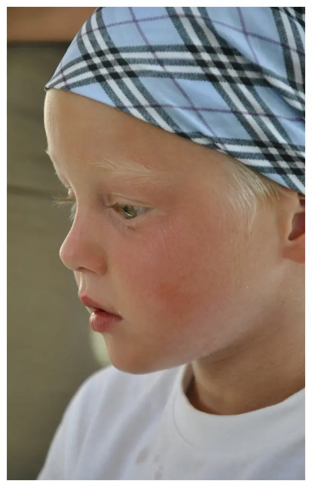 International Albinism Awareness Day: 5 lesser-known facts