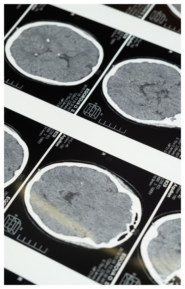 World Brain Tumour Day 2026: 5 facts you shouldn`t miss out